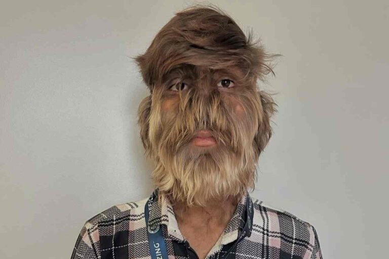 Young person with "werewolf syndrome" breaks the record for "hairiest ...